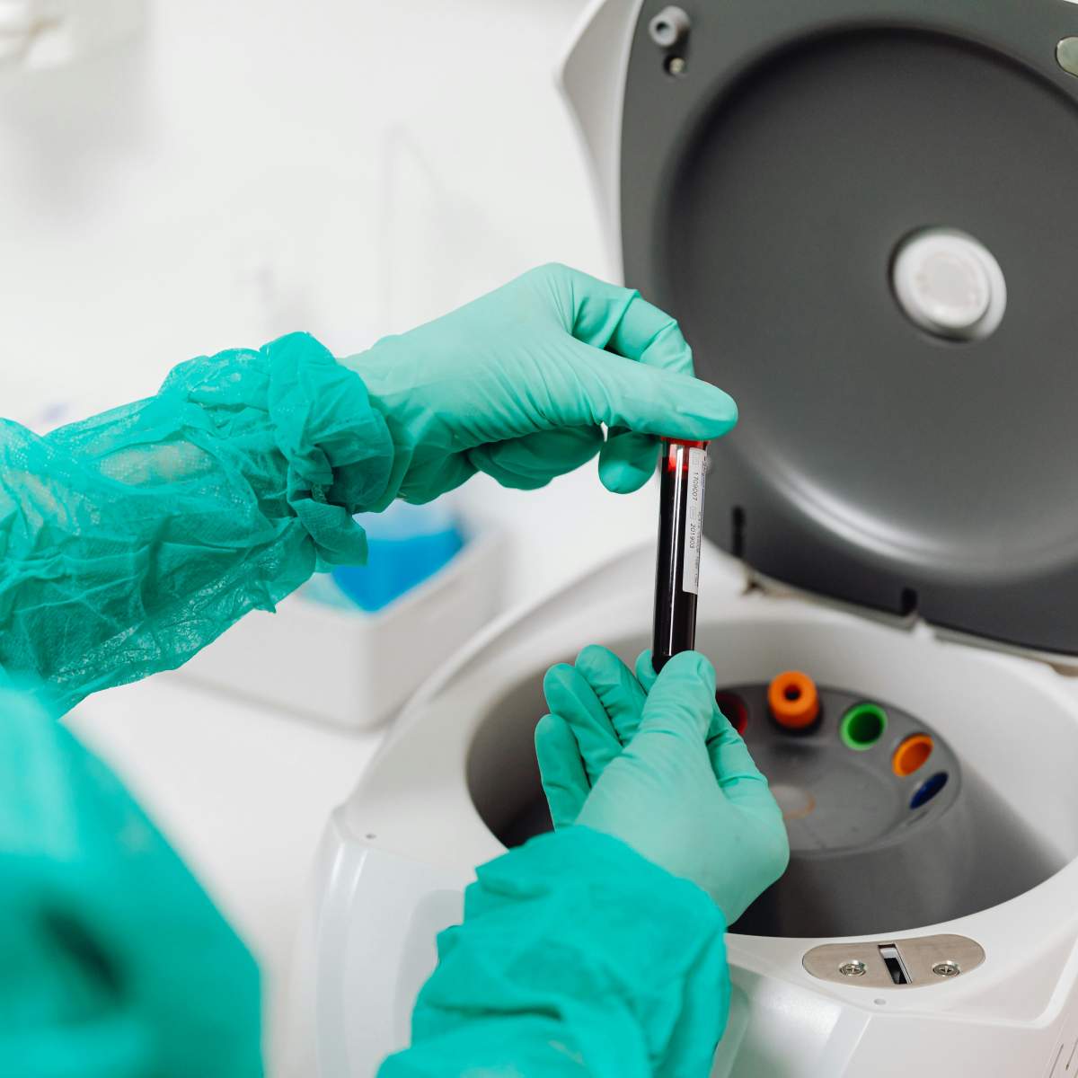 How PRP is Disease-Modifying for Osteoarthritis (OA) - Geraci Spine ...